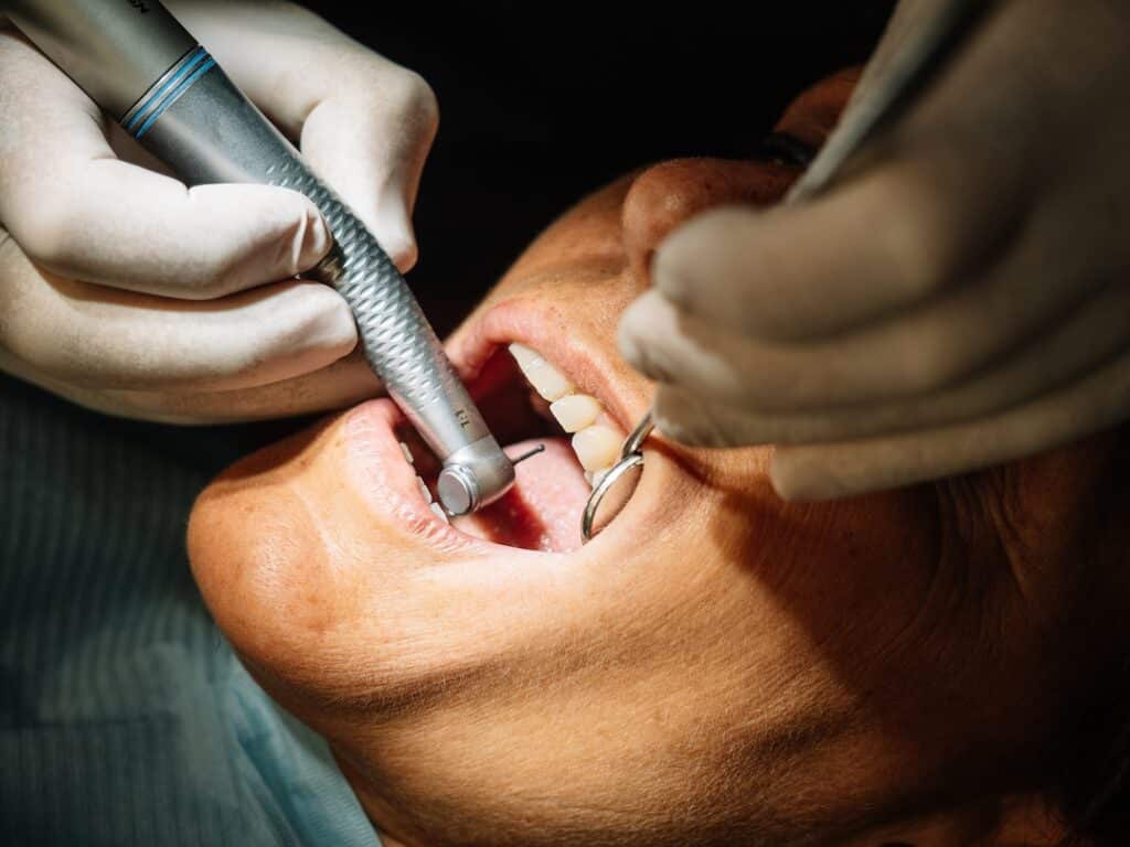 Détartrage dentaire : 5 bienfaits pour des dents saines